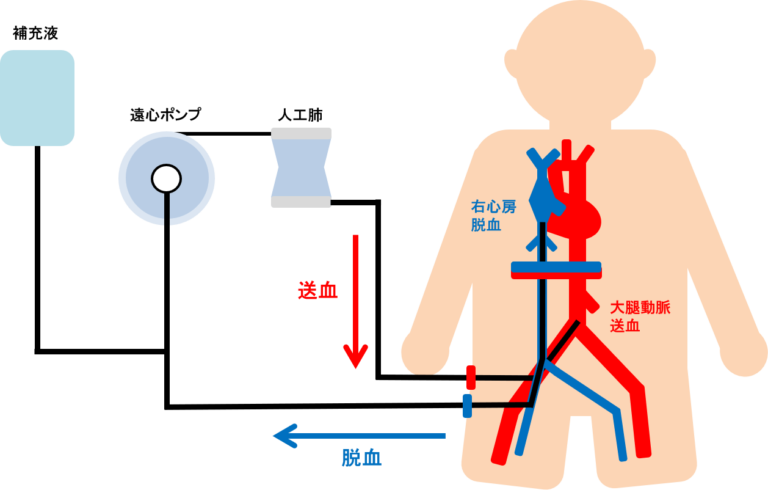VA-ECMOについて【PCPSとの違いは？】